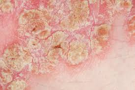 plaques | Natural Psoriasis TreatmentNatural Psoriasis Treatment